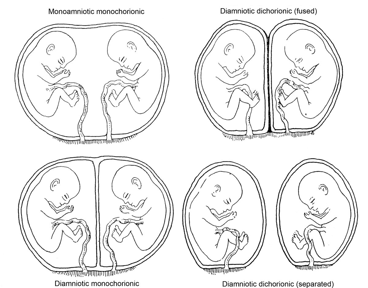 Types Of Multiples Multiples NZ